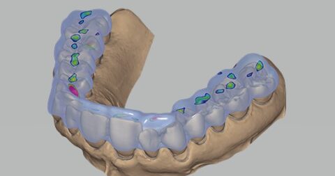 Exocad Perpetual License - Bite Splint - Dentaltechnika